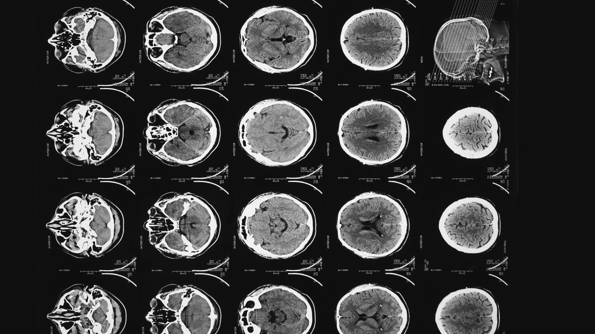 Do Cell Phones Cause Cancer — New Study Says, Maybe?